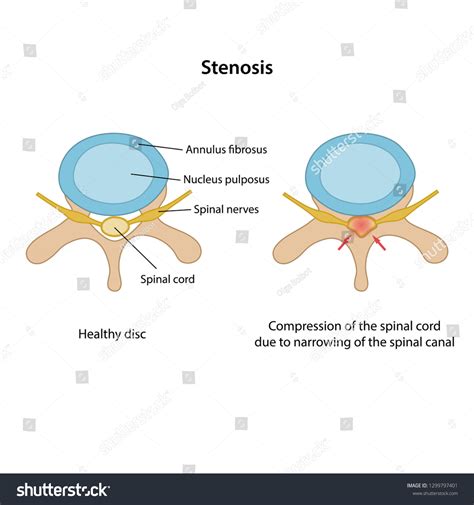 Spinal Stenosis Main Description Healthy Disc Stock Vector Royalty