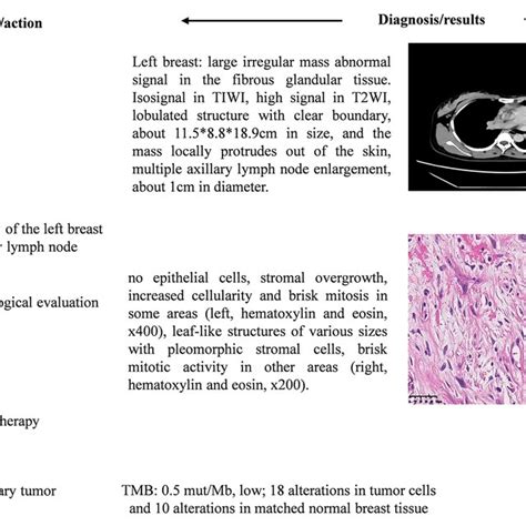 Medical History Of A 33 Year Old Woman With A Malignant Phyllodes Tumor