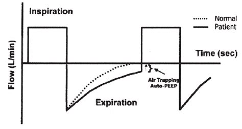 Flow Time Waveform Showing Persistence Of Flow At End Expiration In A