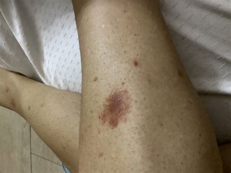 Qualcuno Sa Cosa Possono Essere Queste Macchie Sulla Caviglia E Sui