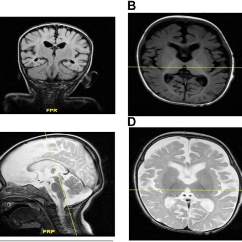 A D Mri Of Individual Ii 1 Revealed Delayed White Matter Myelination