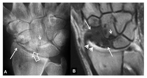 A 41 Year Old Male Patient With A Scaphoid Fracture 5 Years Prior To