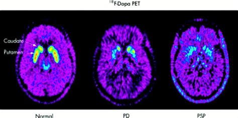 PET Scan How Does PET Scan Work Uses And Side Effects Of PET Scan