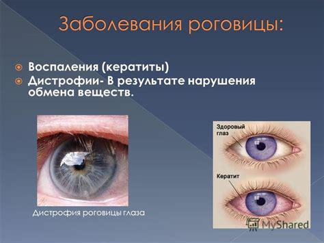 Презентация на тему Кафедра офтальмологии Роговица прозрачная