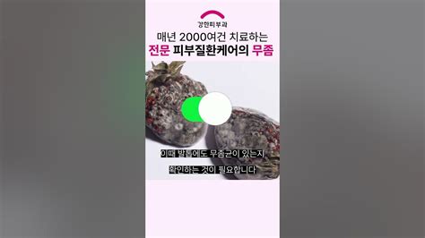 매년2000건 이상 무좀 치료하는 병원🏥 👀 Youtube