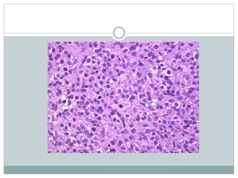 Sex Cord Stromal Tumors Pathology Ppt