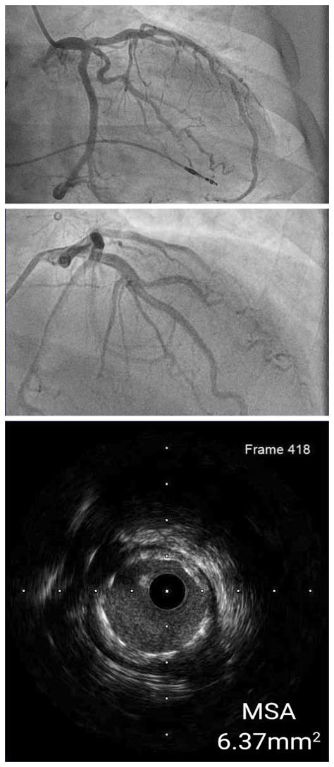 Case 12 Ivus Guided Lad Stent Sizing Cardiology Apps