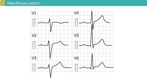 St Segment Elevation In Acute Myocardial Ischemia And Differential