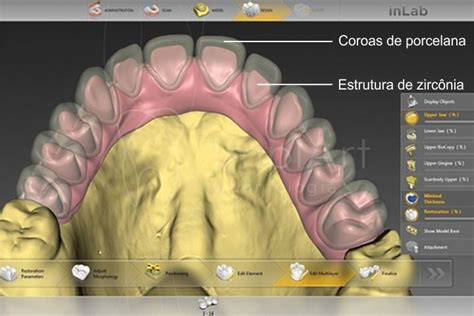 projetando protese fixa zirconia kb Implantes Dentários e Estética Dental