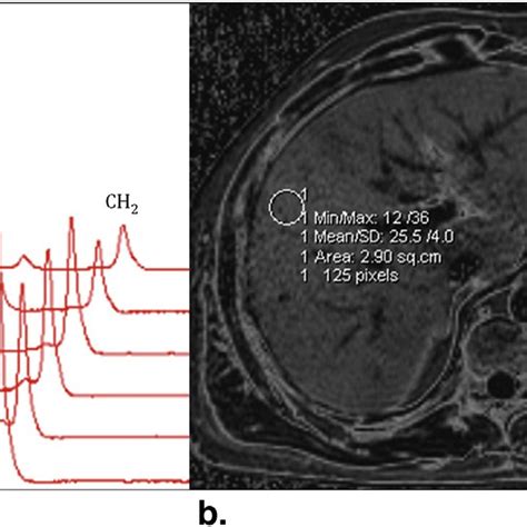 A 1 H Magnetic Resonance Spectra And B Liver Fat Fraction Mapping Download Scientific