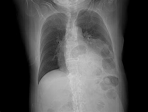 Incidental Ill Defined Nodular Lung Opacities Discovered During Ct
