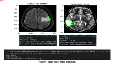 Enhanced Brain Tumor Detection And Stage Prediction Through A Unified