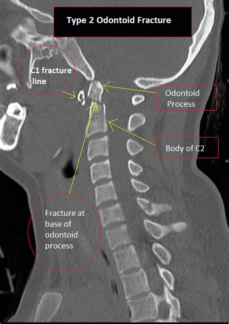 Odontoid Fracture Treatment Modality In Type Ii Odontoid Fractures