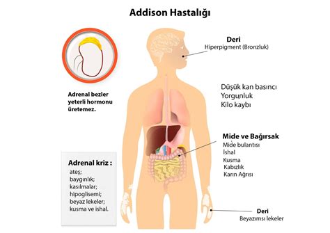 Addison Hastalığı Nedir Sebepleri Belirtileri ve Tedavisi Ogreniyo