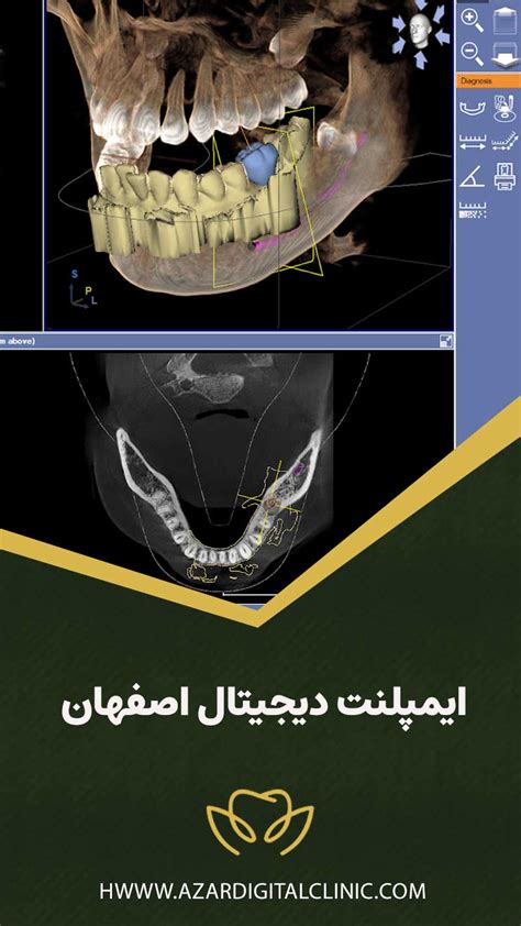 ایمپلنت دیجیتال اصفهان کلینیک آذر