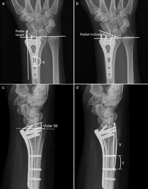 Radiographic Measurements A Radial Height Measurement R Is The