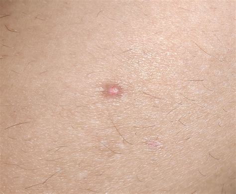 This Spot On My Shin Keeps Opening Up Won T Heal Properly What Is It R DermatologyQuestions