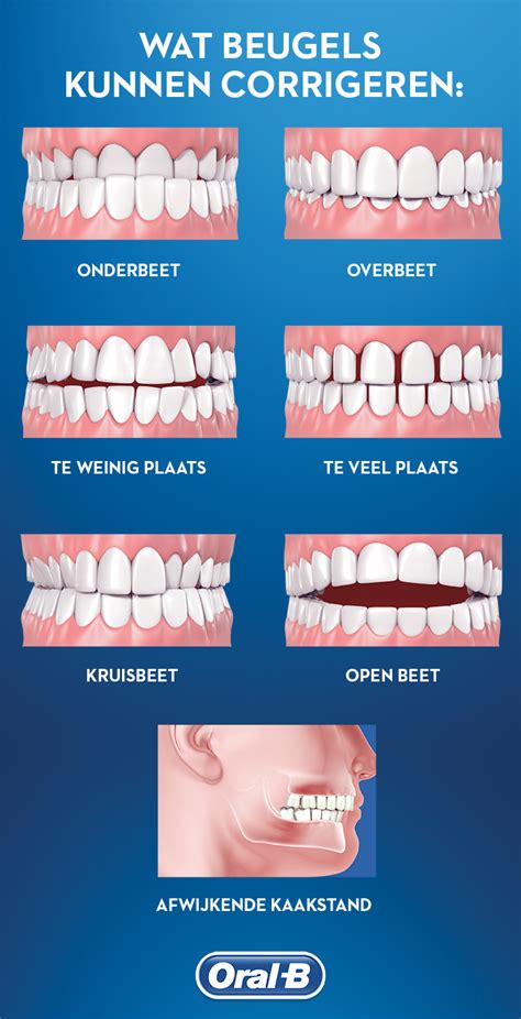 Wanneer Heb Je Een Overbeet Ontdek Het Hier