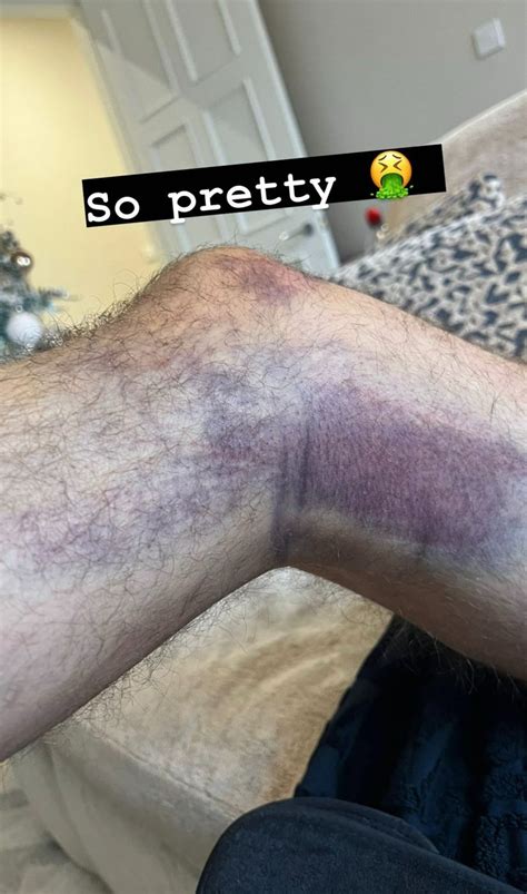 Gary Lucy Shows Off Horrific Injuries Following Car Accident