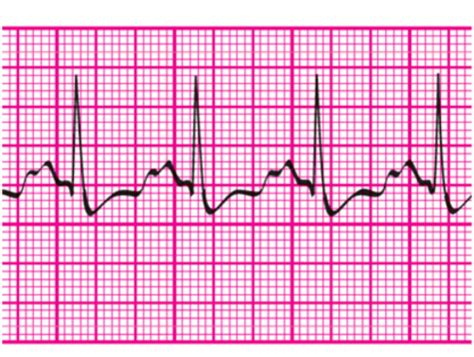Cardiac Review Practice Quiz Questions Flashcards Quizlet