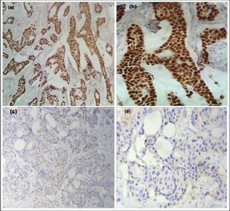 Expression Of Parp1 In Breast Carcinoma A Parp 1 Expression In The
