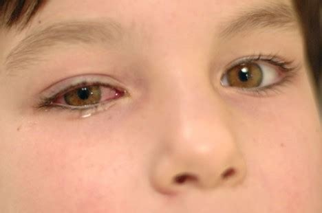 Dete Se Probudilo Crvenog Oka Konjuktivitis Portal Moj Pedijatar