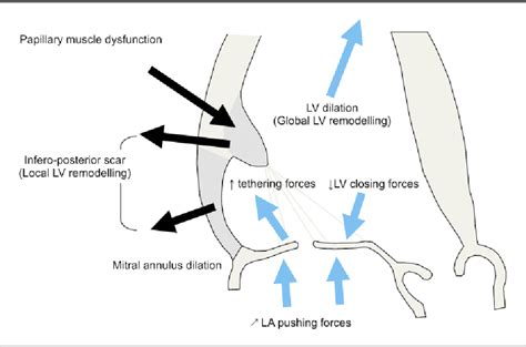 Figure 1 From Secondary Mitral Regurgitation In Heart Failure With