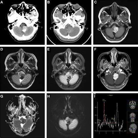 A B Ct Scan Demonstrated A High Density Mass In The Left Cerebellum Download Scientific