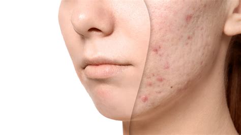 Skincare Ingredients That Can Treat Stubborn Acne Scars
