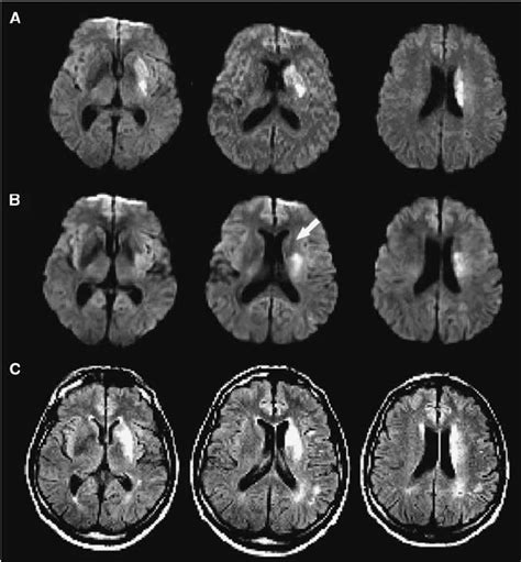 An Example Of Temporary Diffusion Lesion Reversal In A Patient Who