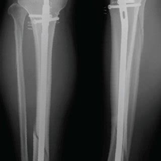 A Anteroposterior And Lateral Radiographs Of The Right Tibia Obtained