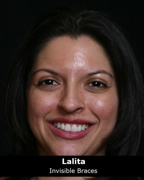 Invisible Braces Gallery Teeth Transformations Amy Norman DDS