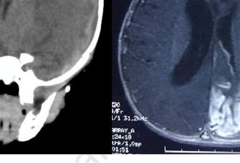 A Ct Brain Showing Subdural Hemorrhage With Midline Shift B Follow Up