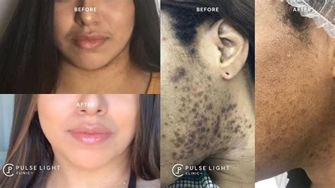 Top 168 How To Reduce Facial Hair Pcos Polarrunningexpeditions