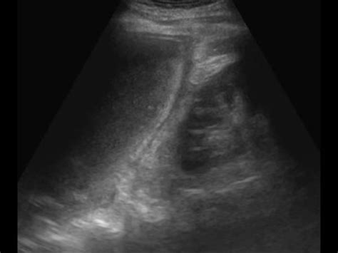 Thorax 8 2 Pleural Space Case 8 2 1 Effusion And Empyema Ultrasound Cases