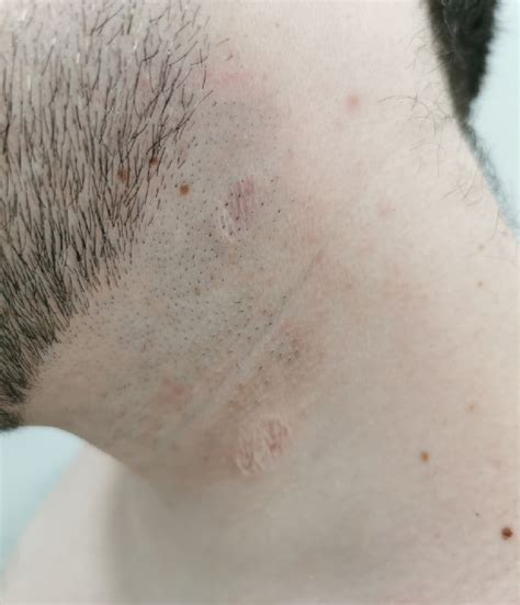 Clinical Manifestations Of Jadassohn Anetoderma In Patient E 34 Years