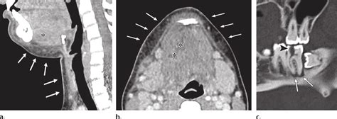 Ludwig Cellulitis A B Sagittal A And Axial B Contrast Enhanced Download Scientific