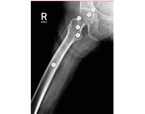 Lateral Proximal Femur Quiz