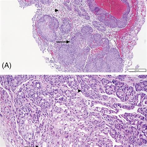 Histopathology Of The Second Biopsy A Polypoid Mucosal Hyperplasia Download Scientific