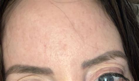 Forehead Acne Scars Scar Treatments Forum