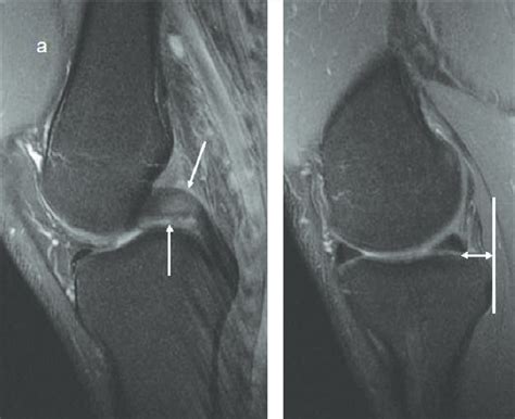 A The Pcl Has High Signal In The Proximal Part But The Peripheral Download Scientific