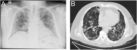 Lung Imaging Showing Diffuse Interstitial Lung Disease A Chest Download Scientific Diagram