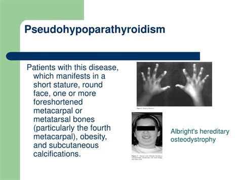 Pseudohypoparathyroidism Face