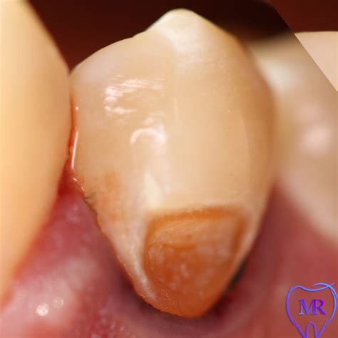 Cervical Caries Tooth 3 4 🦷 Dr Mohammad Radi Alhalalmah