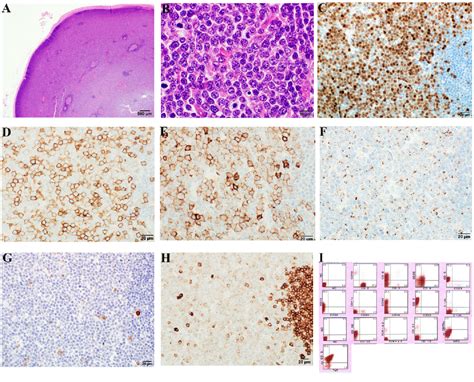 Figure 2 From Coincidence Of De Novo T Lymphoblastic Lymphoma And