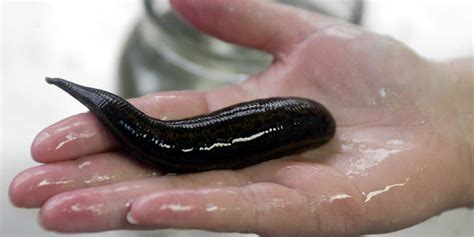 Leech Therapy In Brooklyn Business Insider