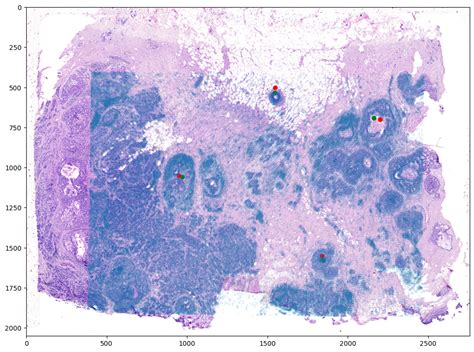Aligning Single Cell Resolution Breast Cancer Spatial Transcriptomics Data To Corresponding Hande