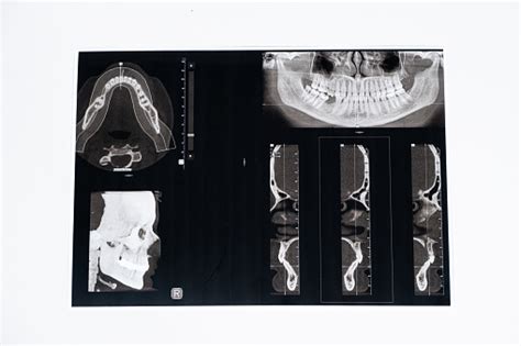 부정 교합 씹는 치아 누락 및 악관절 관절 기능 장애 환자의 Ct 스캔 턱 관절에 대한 스톡 사진 및 기타 이미지 턱 관절