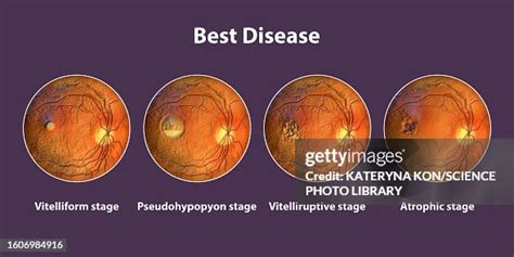 Stages Of Best Vitelliform Macular Dystrophy Illustration High Res Vector Graphic Getty Images