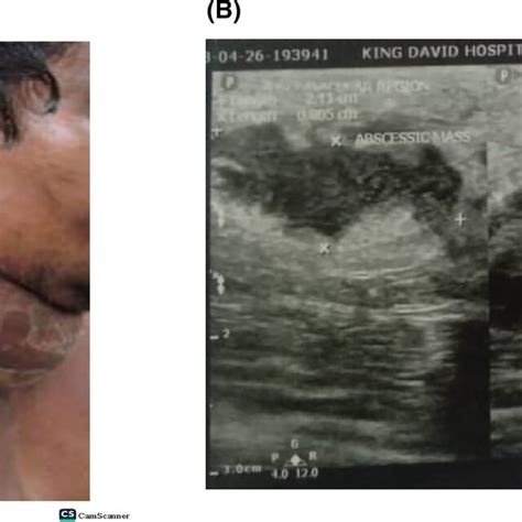A Visible Anterior Neck Swelling B Ultrasound Scan Shows Extensive Download Scientific